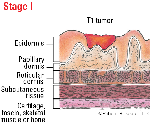 Skin Cancer Staging