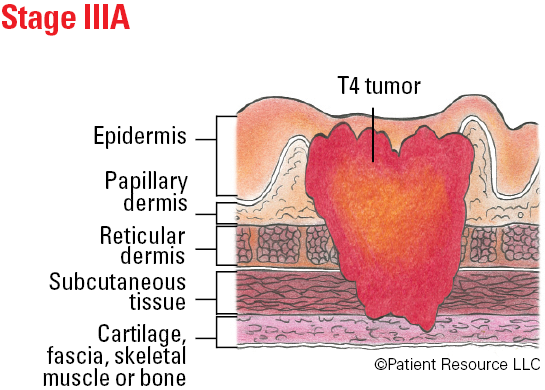 Skin Cancer Staging